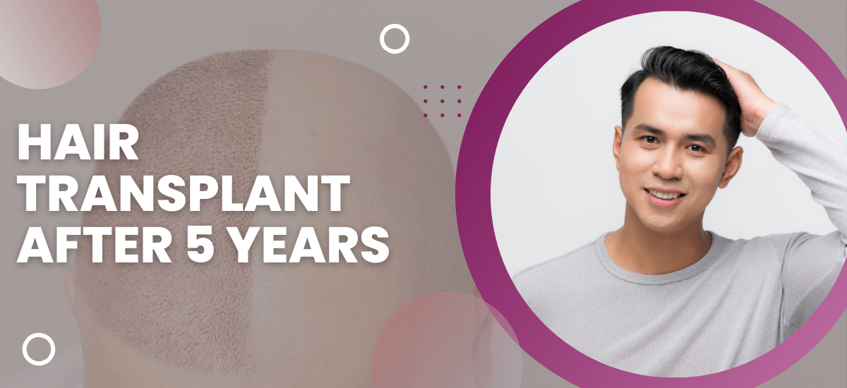 Hair Transplant After 5 Years | Dr. Vinod Vij